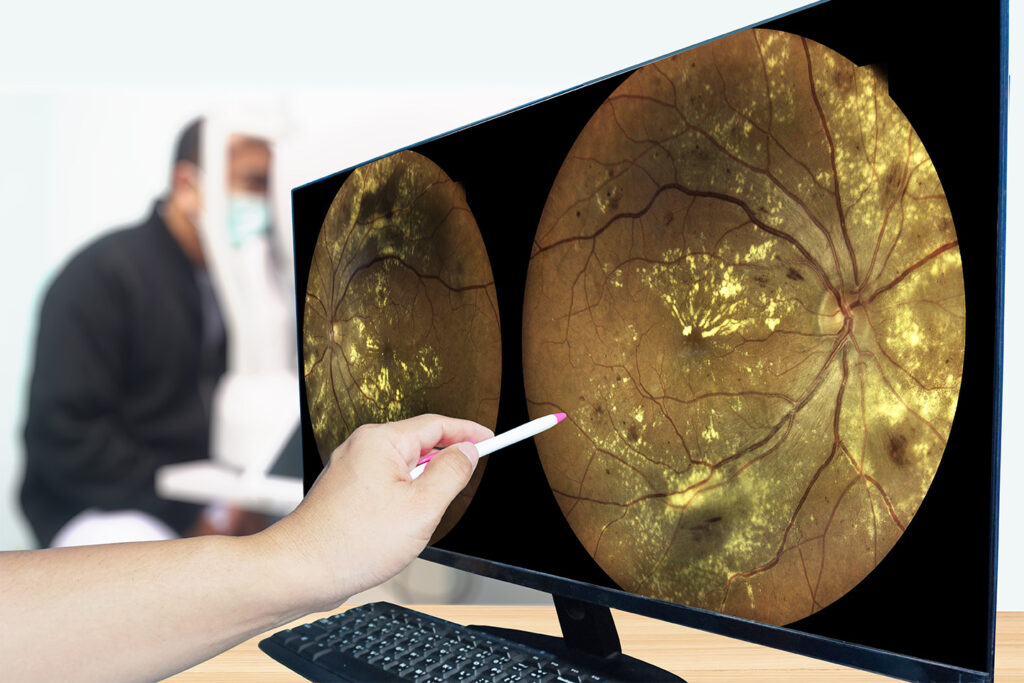 Can Diabetic Retinopathy Be Reversed? Exploring Treatment Options ...